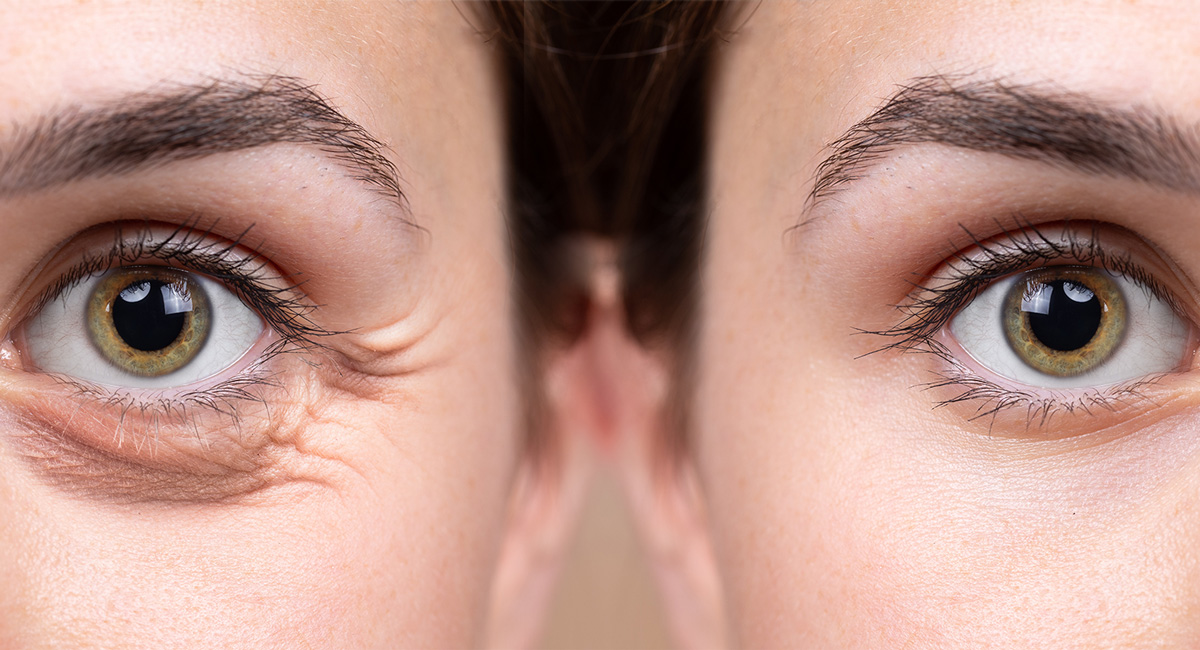 Samantha’s Under Eye Transformation - Escape Aesthetics Dunstable